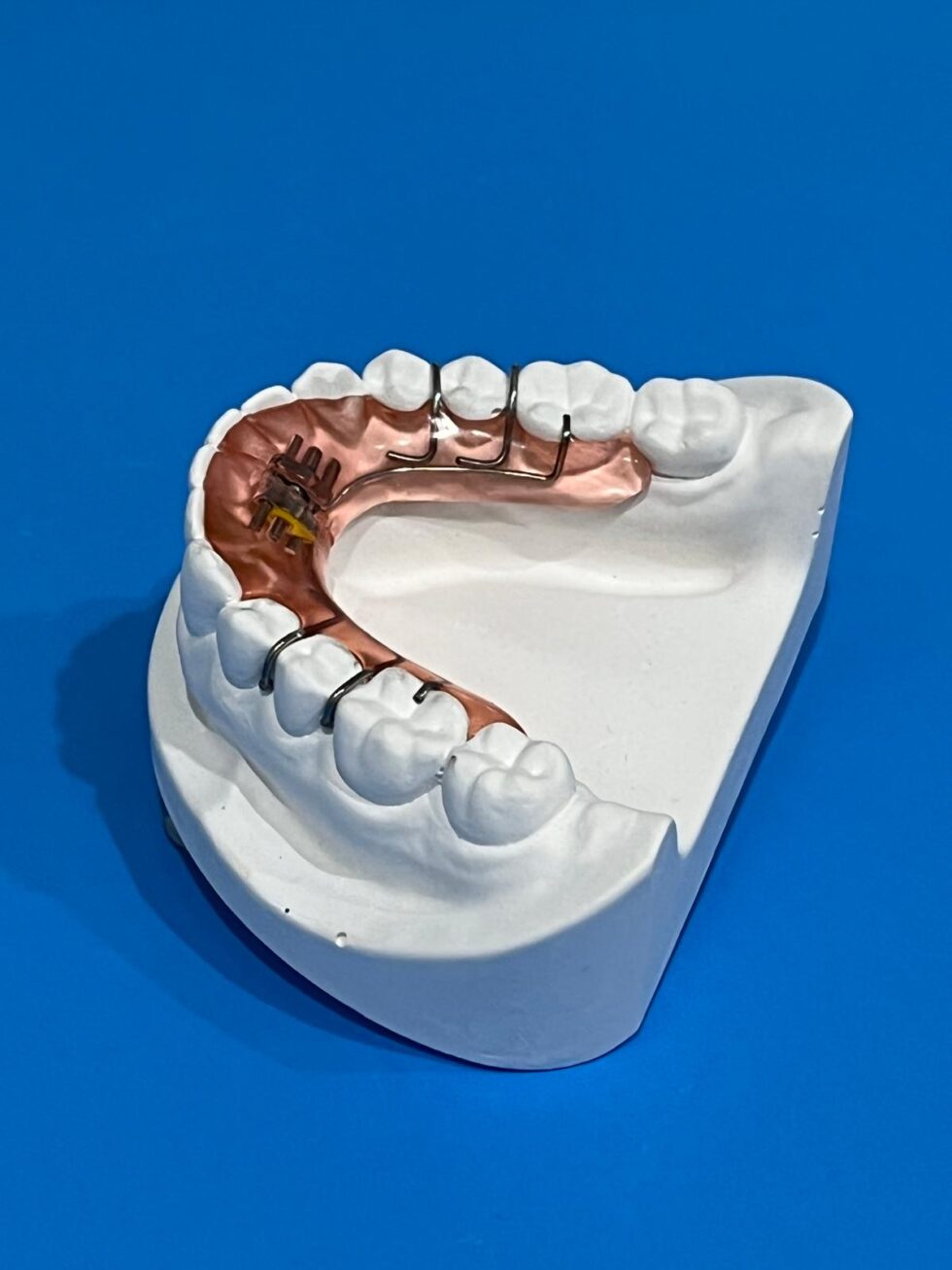The Benefits of Functional Appliances in Orthodontics | Victory ...